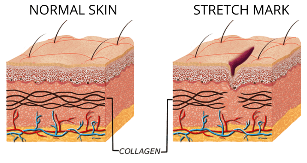 Why do stretch marks appear? What You Need to Know | Scar Camouflage ...